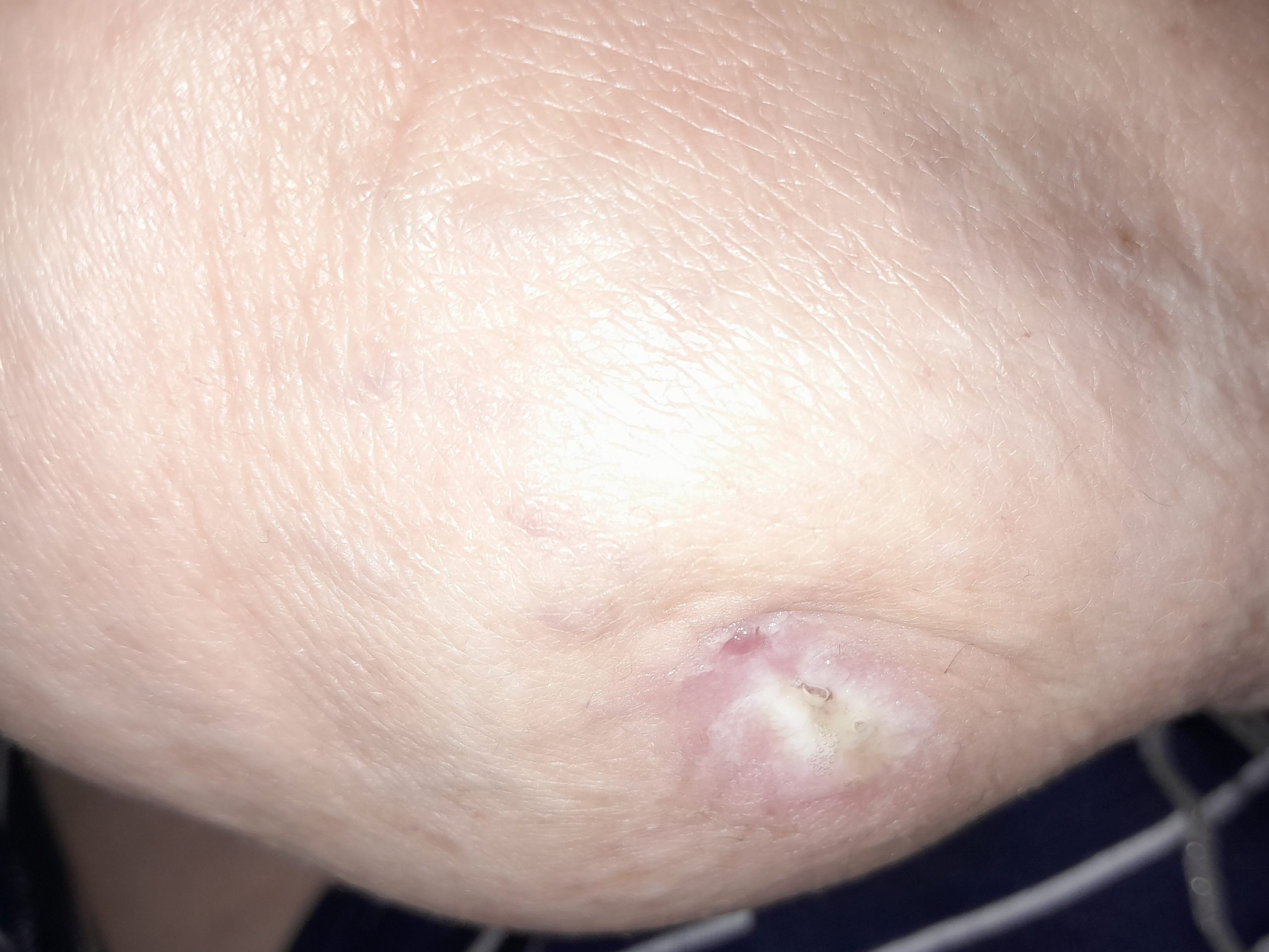 More Pressure Relief